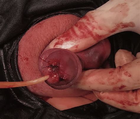 Bilateral Percutaneous Distal T Shunt After Closure Of Incisions On Download Scientific Diagram