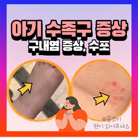 수족구초기증상 수포 아기 구내염증상 약 격리기간 네이버 블로그