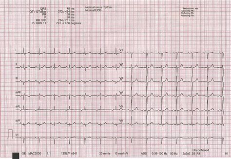 Ekg Elektrokardiogramm Einfach Erklärt