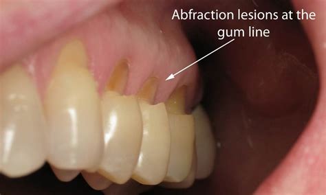 Tooth Abfraction Fix