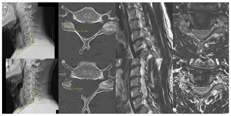 Endoscopic Cervical Decompression At Donte Galiano Blog