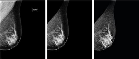 Pre Processing A Original Mammogram B Pectoral Muscle Removal And