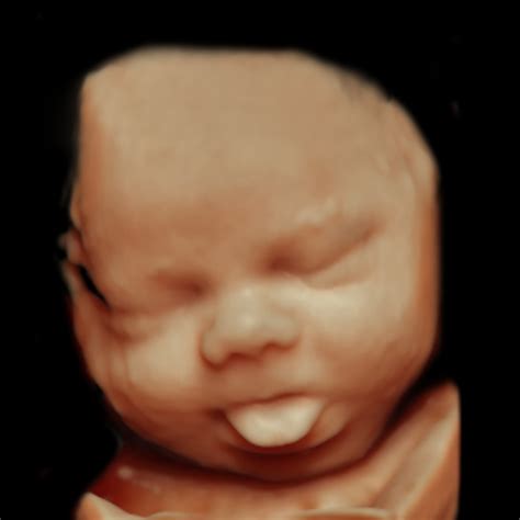 3d Ultrasound