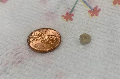Severe Tonsil Stones Gettting Tonsils Removed Soon Rtonsilstones