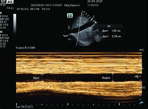 Ultrasound Imaging Ivc In The Supine Position Download Scientific Diagram
