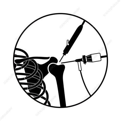Shoulder Arthroscopy Procedure Illustration Stock Image F0428278