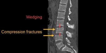 Abdominal Ct Spinal Fractures • Litfl • Radiology