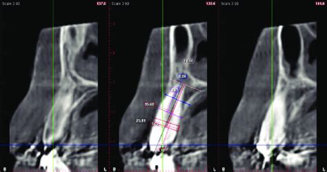 Assessment Of Root Resorption Using Cbct Download Scientific Diagram