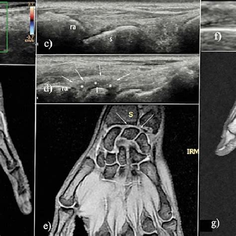 Female 32 Years Old 3rd Mcp Joint A Longitudinal Ultrasound With