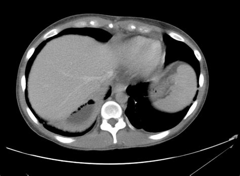 03 Pyelo Differential Diagnosis Of