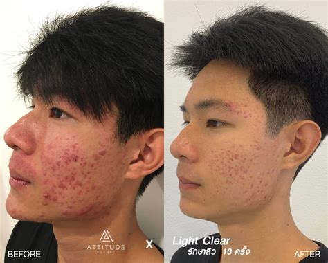 รีวิวรักษาสิว ที่แอททิจูดคลินิก • รีวิวรักษาสิว ที่แอททิจูดคลินิก ร้าน