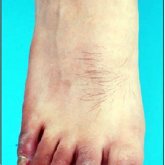 Ct Angiography Of The Lower Limbs Showing Distal Posterior And Anterior