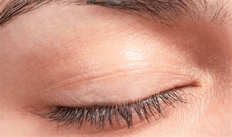 Eyelid Rash Facts