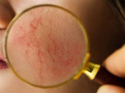 Lupus Vs Rosacea Differences Strong Causes And More 2025