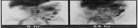 A Case Of Cap Polyposis Investigated By Scintigraphy With Hu Clinical Nuclear Medicine