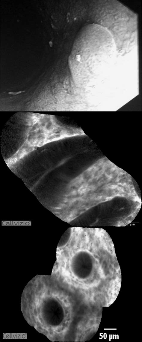 A Endoscopic Appearance Of A Slightly Raised Lesion Iia Paris