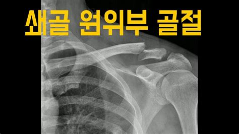 쇄골 원위부 골절 리더스병원 Youtube