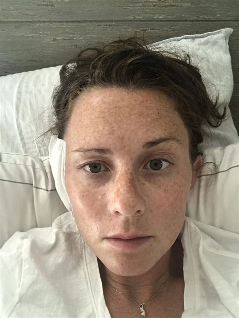 My Mohs Surgery Experience For Basal Cell Carcinoma Caitlin Houston