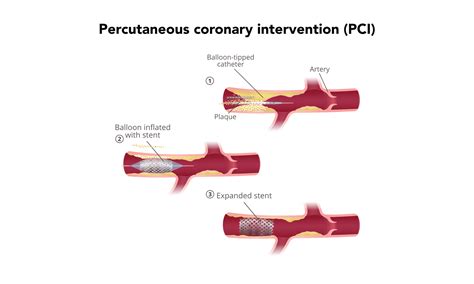 Managing Stemi Treatment Of Stemi Guidelines Acls Certification
