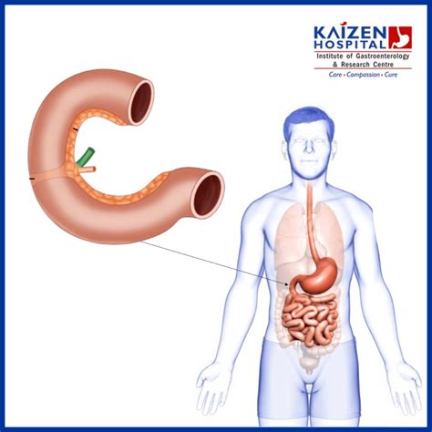 How Long Does It Take For A Duodenum Ulcer To Heal U Kaizenhospitals