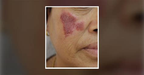 A Case Of Facial Erythema Due To Lupus Vulgaris And Candida Albicans