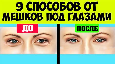 Как быстро избавиться от мешков под глазами 9 эффективных способов от синяков под глазами Youtube