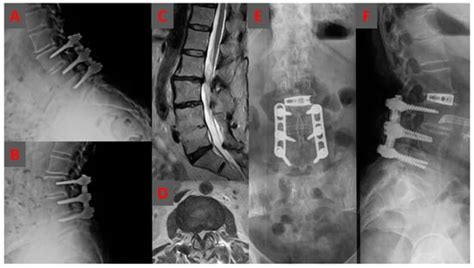 Jcm Free Full Text Stand Alone Oblique Lumbar Interbody Fusion