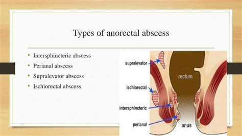 Solution Anorectal Abscess Studypool