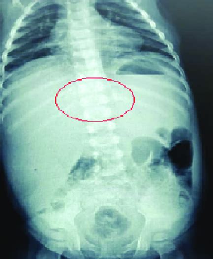 A Picture Of Asp Of Our Patient Showing Adrenal Calcification