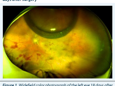 Figure 4 From Postoperative Hemorrhagic Occlusive Retinal Vasculitis Associated With