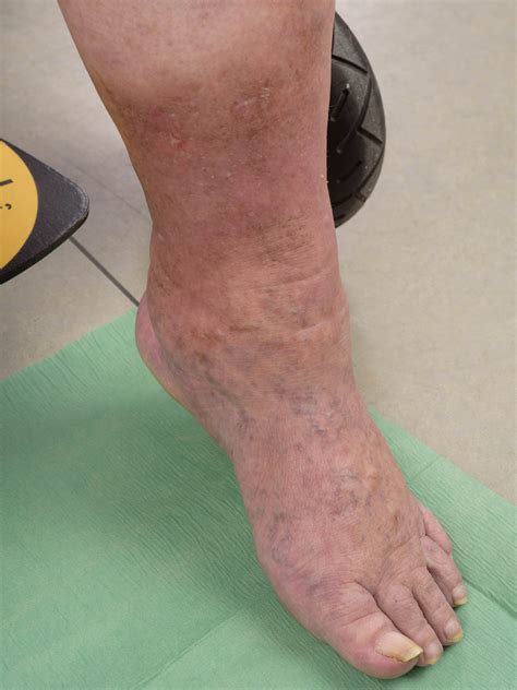 Lipodermatosclerosis En Hypodermitis
