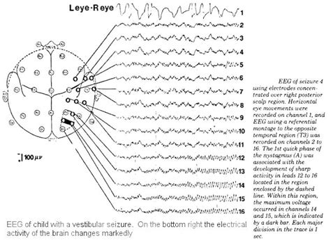 Seizure Eeg Patterns