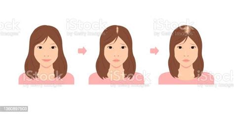 여성 안드로유전학 탈모증의 진행 벡터 일러스트레이션 탈모에 대한 스톡 벡터 아트 및 기타 이미지 탈모 머리가 빠지다 여성