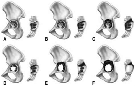 Clasificación Osteólisis Acetabular De Paprosky A Tipo I B Tipo