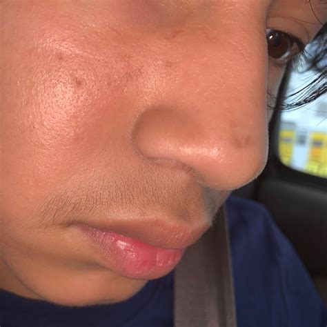 Bump On Nose