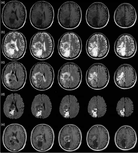 Figure 1 From Epidermoid Cyst In Atypical Intracranial Areas