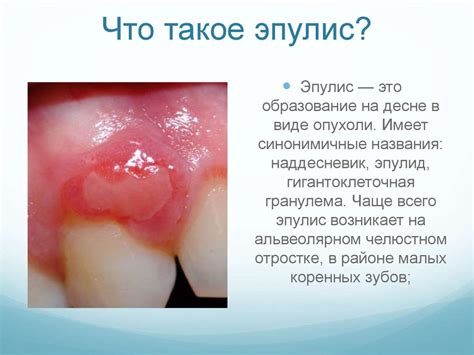 Эпулис - online presentation