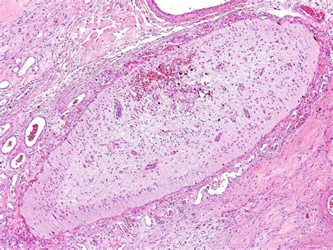 4b3 Encephalocele Case 4 Hande 3 Encephalocele Developmental Malformations Washington