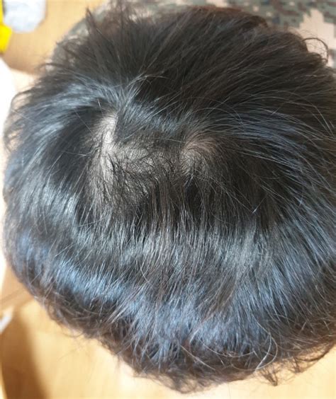 동성제약 미녹시딜 사용법 및 5개월 사용후기 네이버 블로그