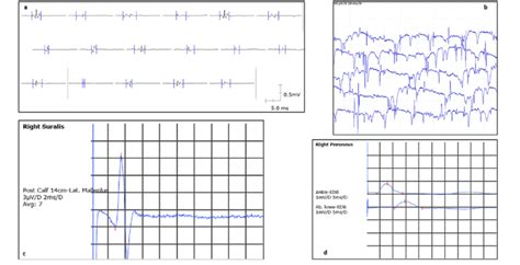 Patient 1 A Myopathic Pattern Short Duration And Amplitude 5 3 Ms