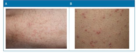 Folliculitis In Two Tapinarof Treated Patients In Psoaring 1 And 2 A