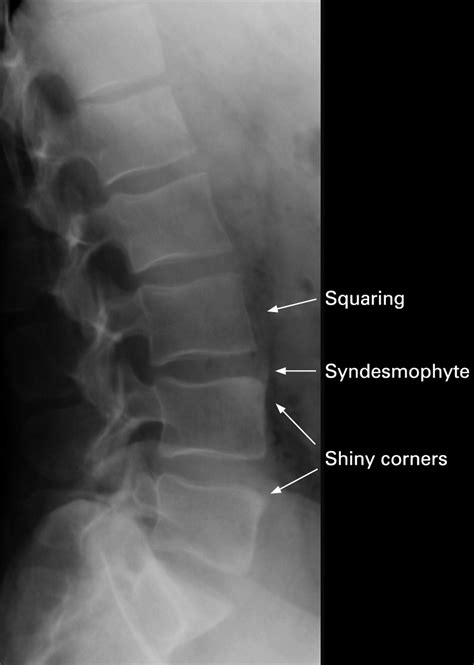 Ventral Syndesmophytes And A Medial Erosion Of The Lumbar