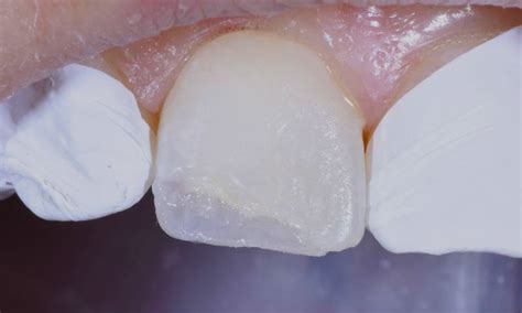 Step By Step Protocol For Consistently Creating Invisible Class Iv Res Clinical Research Dental