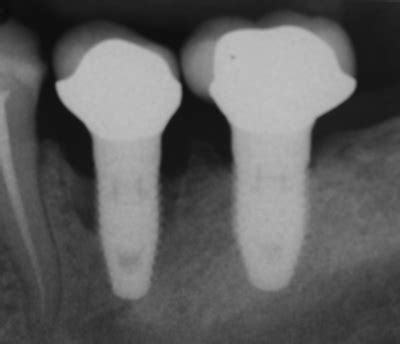 Periodontium Development Histology And Embryology For Dental Hygiene