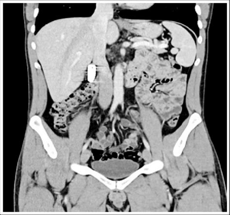 Computer Tomography Ct Image Of Battery In The 2nd Part Of The Duodenum Download Scientific