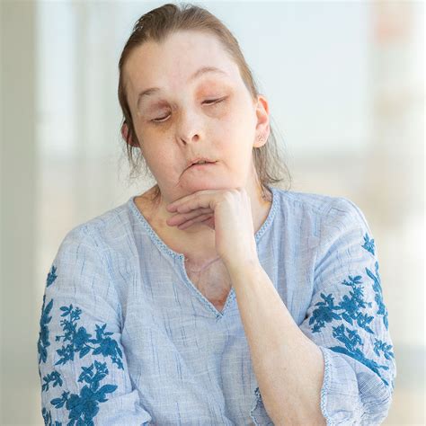 When Face Transplants Fail Carmen Tarleton Interface