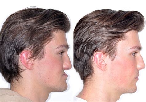 Case 4 Cleft Upper And Lower Jaw Surgery Sydney Oral And Facial Surgery