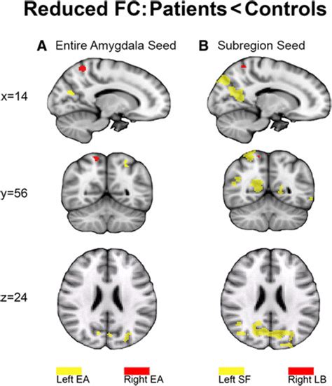 Areas Of Reduced Functional Connectivity In Asd A Significant P Download Scientific Diagram
