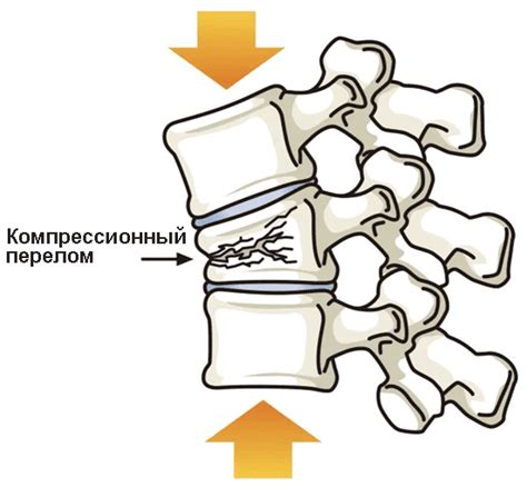 Компрессионный перелом лечение — International Lumbago Clinic