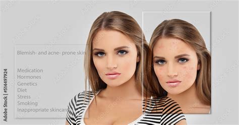 Acne Skin Concern Blemish Prone Skin And Acne Rosacea Different Types Of Acne Stock Photo